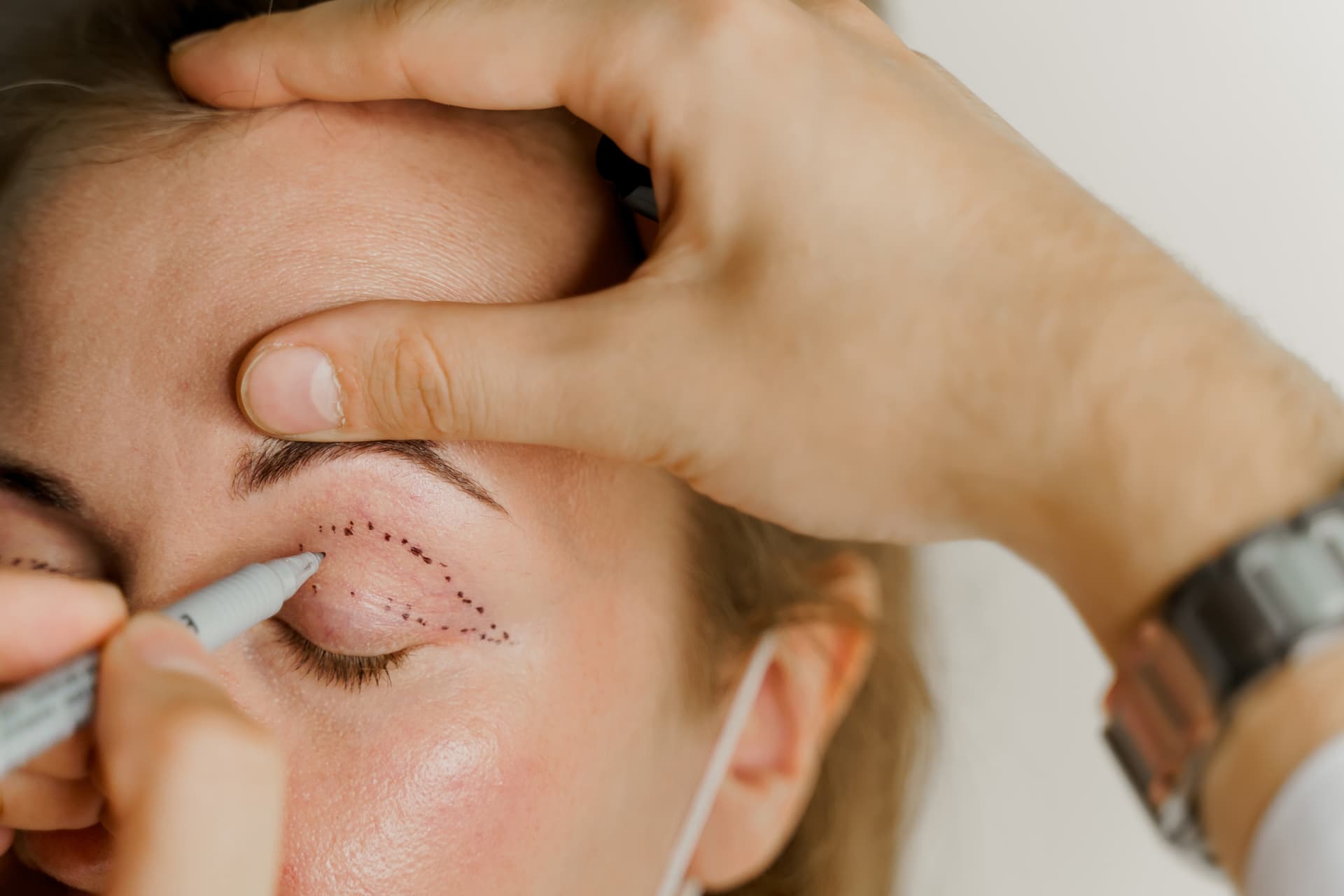 Blépharoplastie supérieure à Nantes | Paupières tombantes | Dr Ruiz